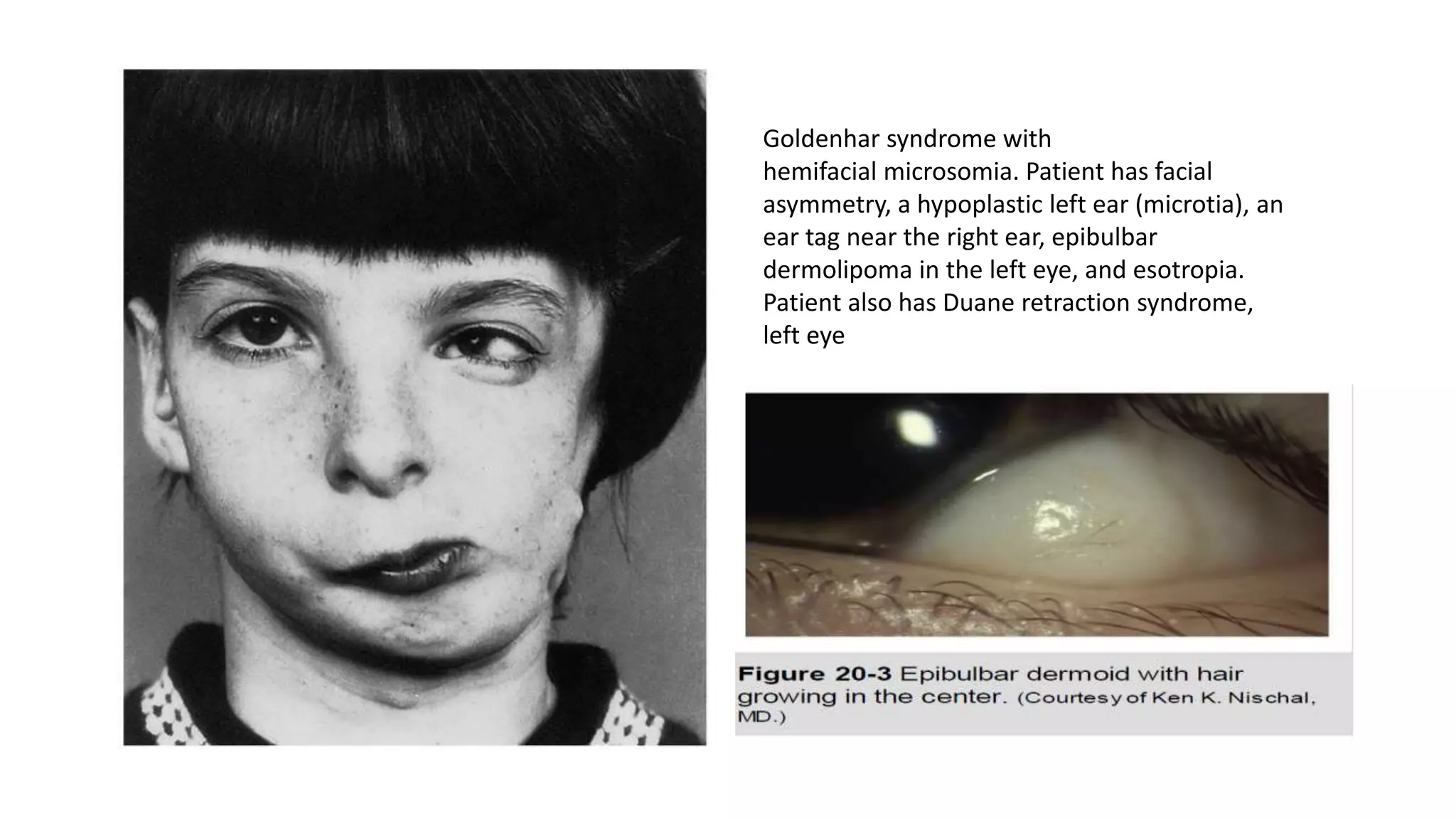 Duane Retraction Syndrome- Congenital Cranial Dysinnervation Disorder ...