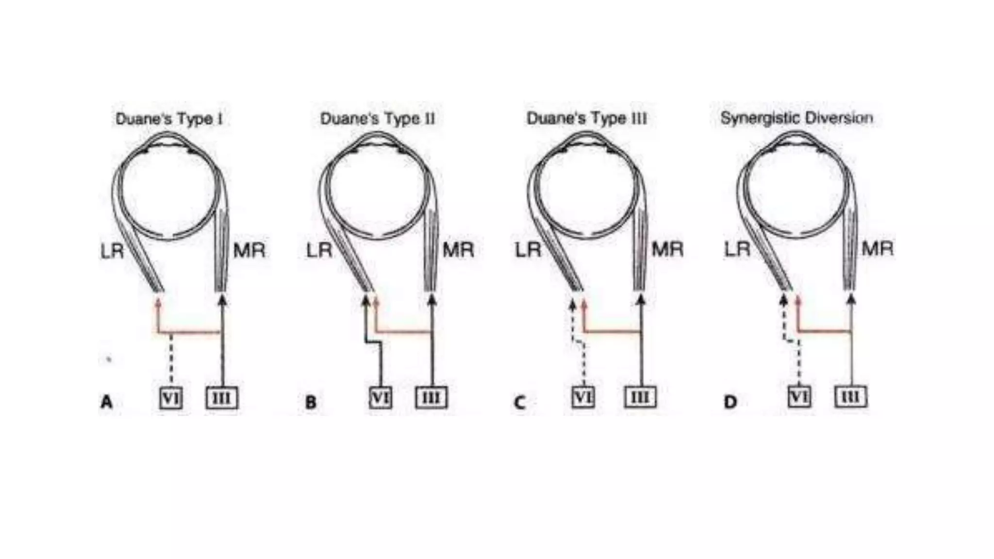 Duane Retraction Syndrome- Congenital Cranial Dysinnervation Disorder ...
