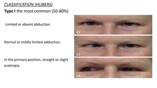 Duane Retraction Syndrome- Congenital Cranial Dysinnervation Disorder ...