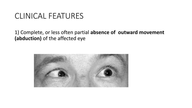 Duane Retraction Syndrome- Congenital Cranial Dysinnervation Disorder ...