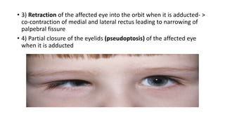 Duane Retraction Syndrome- Congenital Cranial Dysinnervation Disorder ...