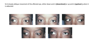 Duane Retraction Syndrome- Congenital Cranial Dysinnervation Disorder ...