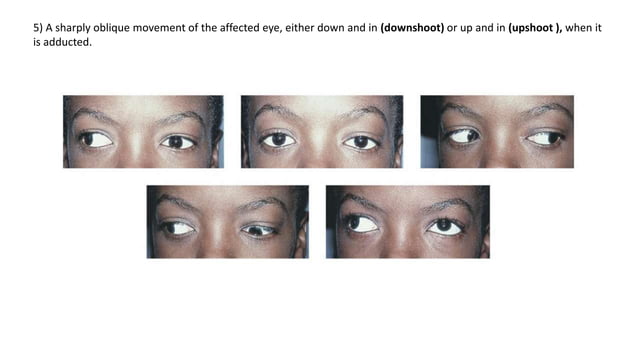 Duane Retraction Syndrome- Congenital Cranial Dysinnervation Disorder ...