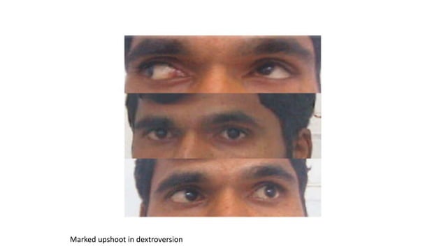 Duane Retraction Syndrome- Congenital Cranial Dysinnervation Disorder ...