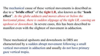 Duane Retraction Syndrome- Congenital Cranial Dysinnervation Disorder ...