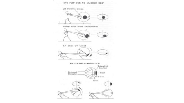 Duane Retraction Syndrome- Congenital Cranial Dysinnervation Disorder ...
