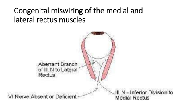 Duane Retraction Syndrome- Congenital Cranial Dysinnervation Disorder ...