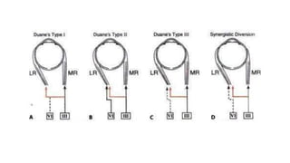 Duane Retraction Syndrome- Congenital Cranial Dysinnervation Disorder ...