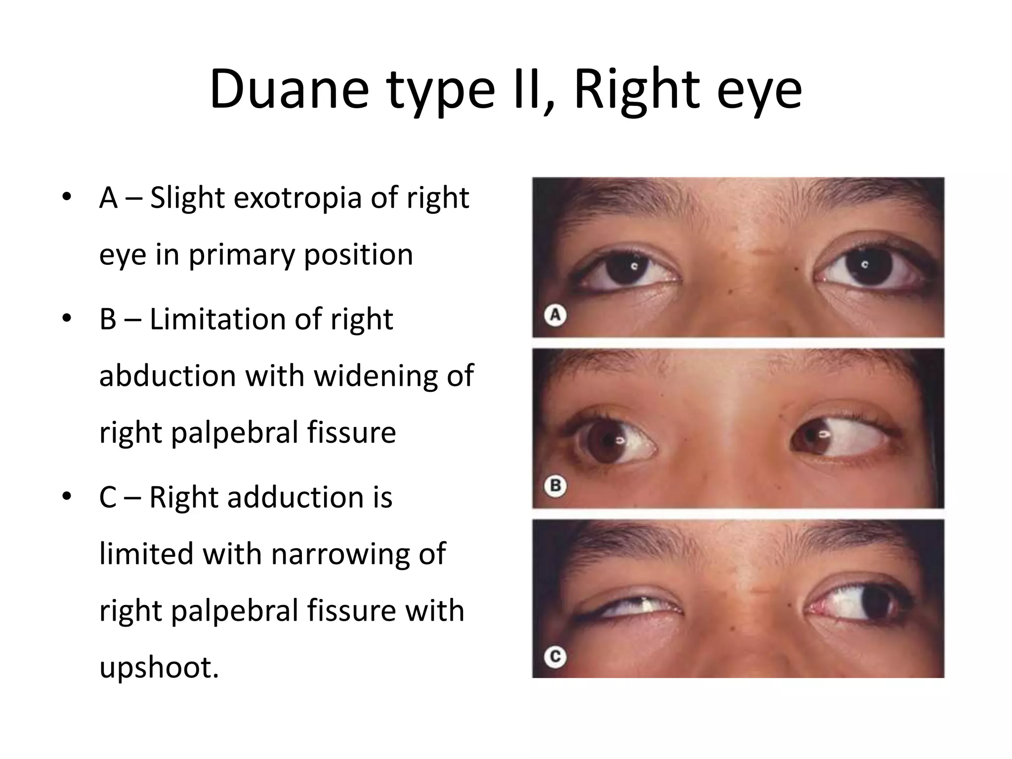 Duane Retraction syndrome.pptx