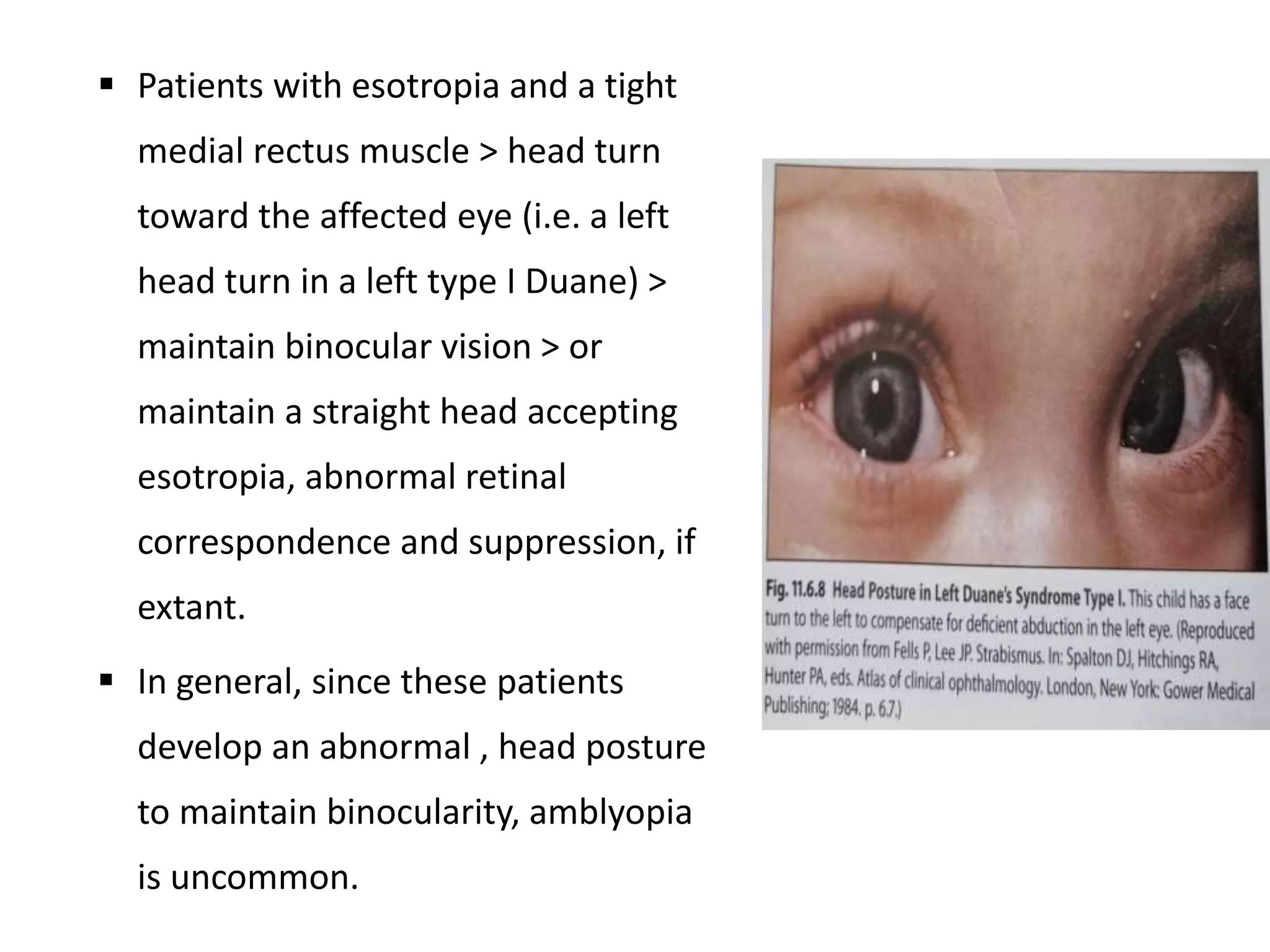 Duane Retraction syndrome.pptx