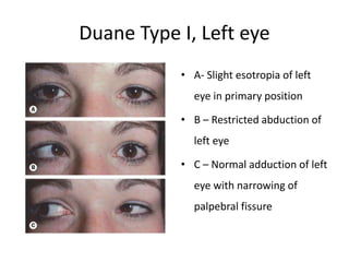 Duane Retraction syndrome.pptx