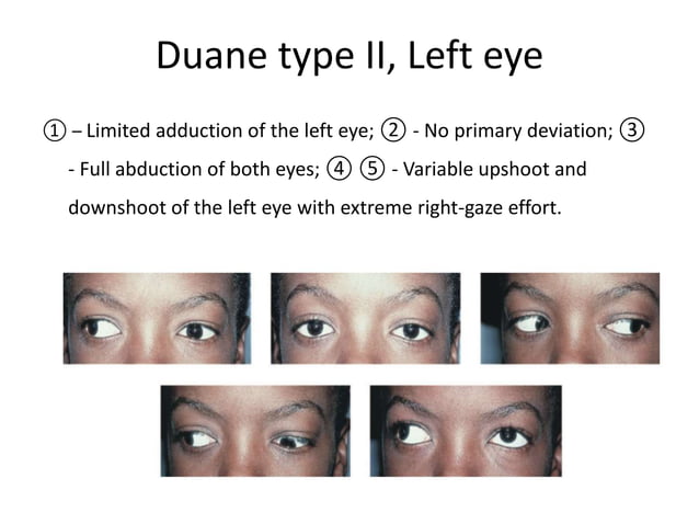 Duane Retraction syndrome.pptx