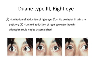 Duane Retraction syndrome.pptx