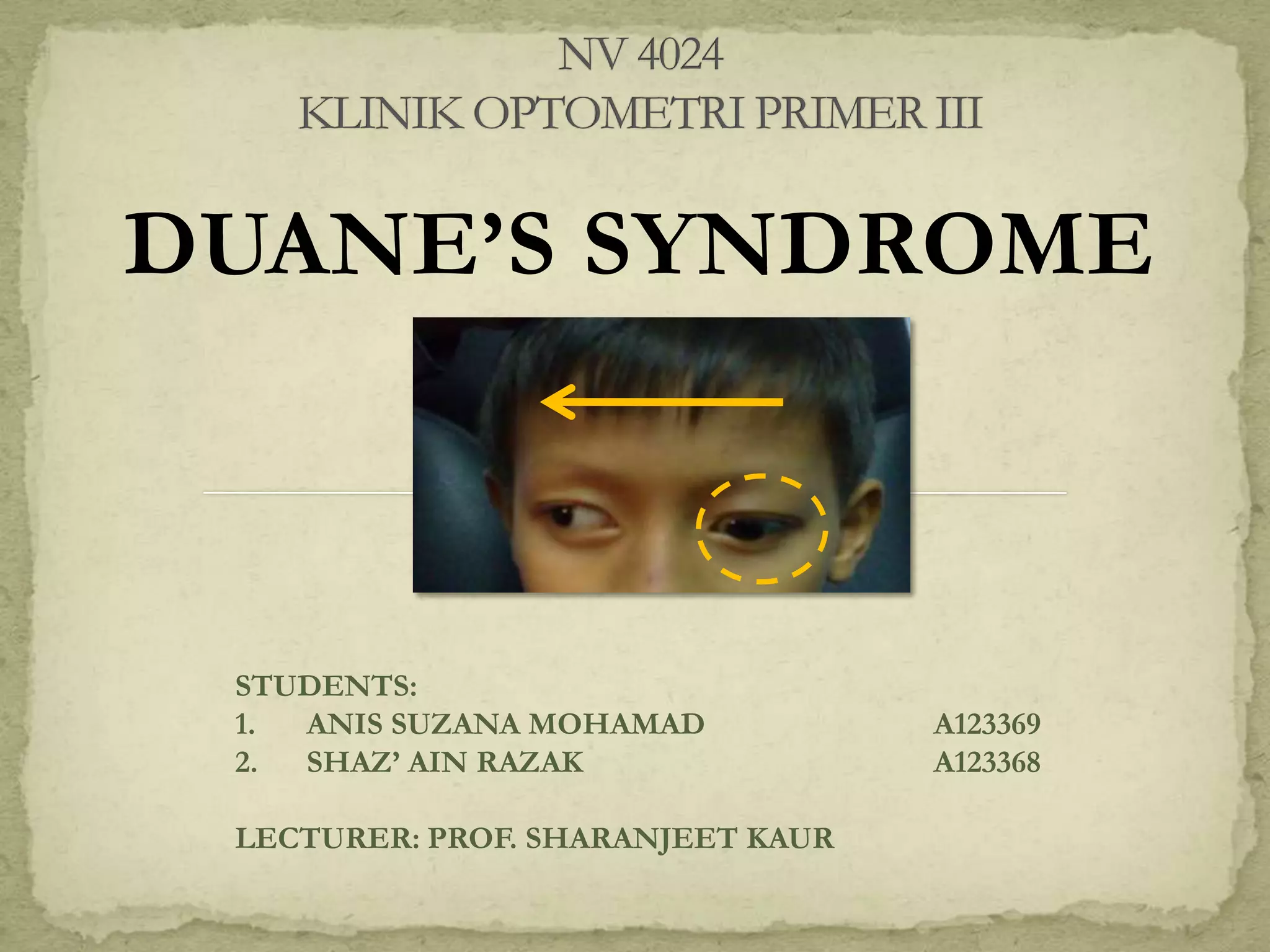 Case Presentation: Duane's Syndrome | PPTX