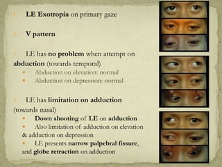 Case Presentation: Duane's Syndrome | PPTX