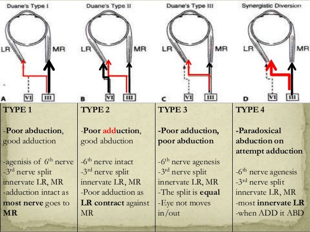 Case Presentation: Duane's Syndrome