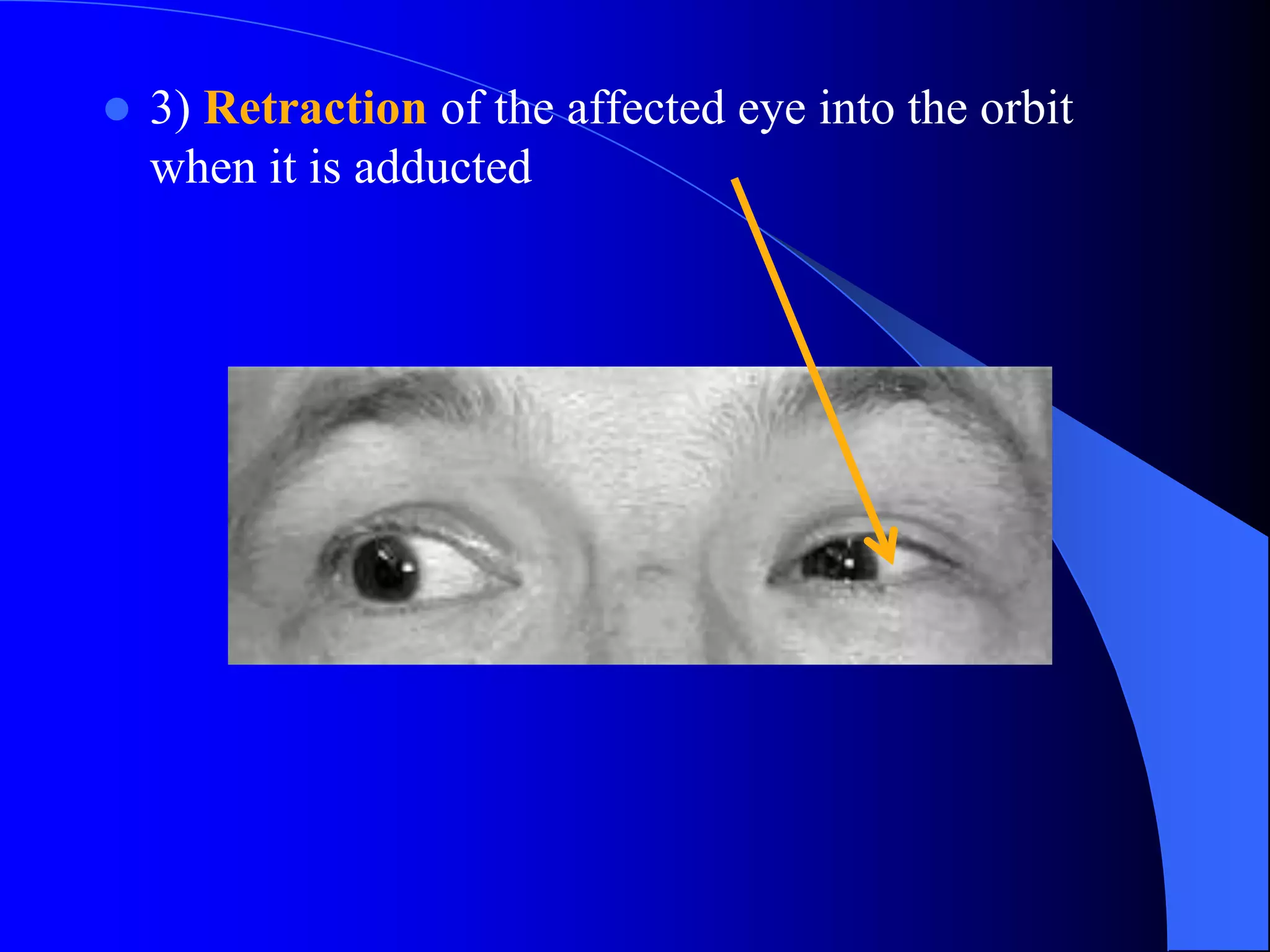 Duanes retraction syndrome .. | PPTX