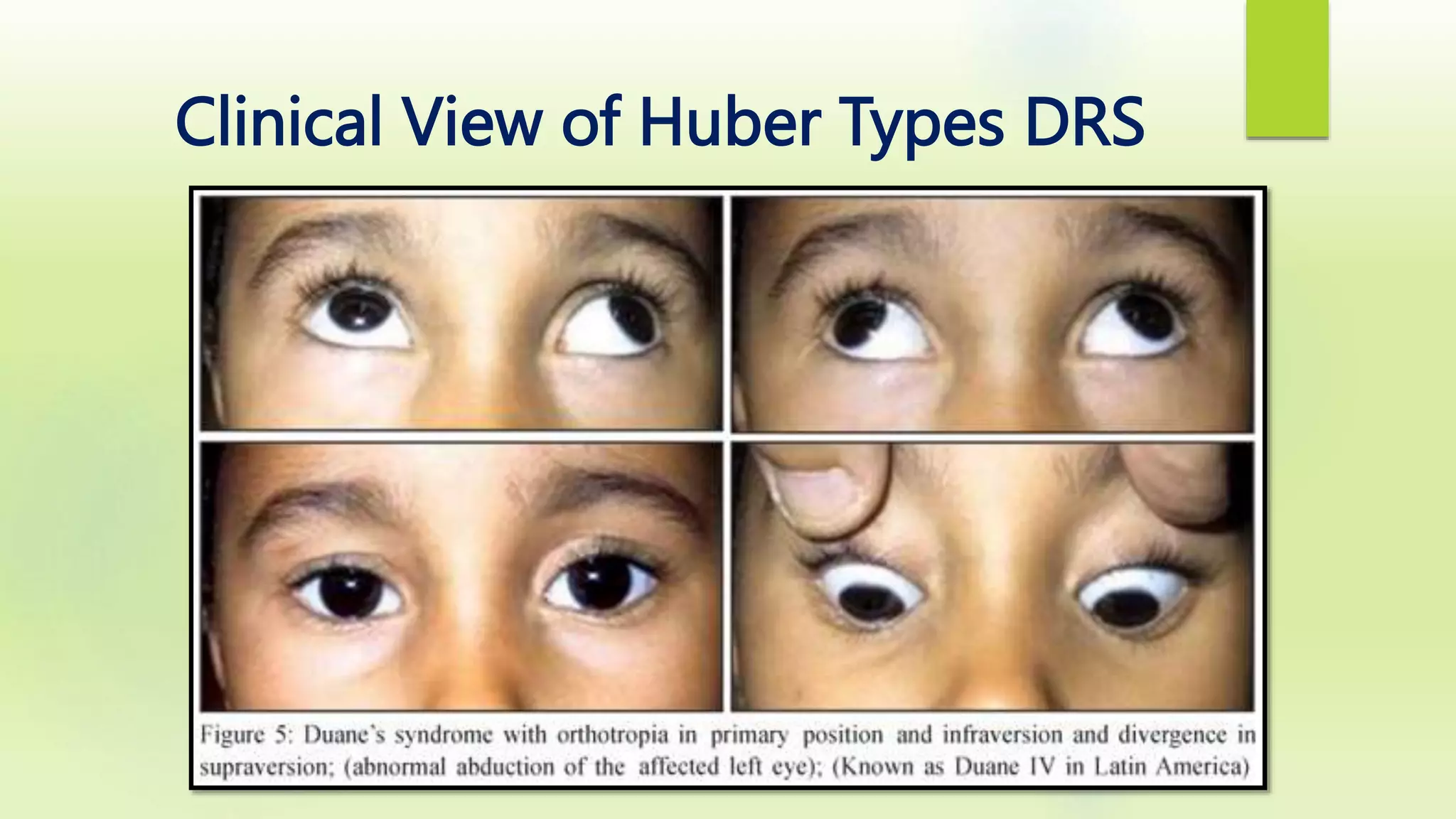 Duane's Retraction Syndrome.pptx