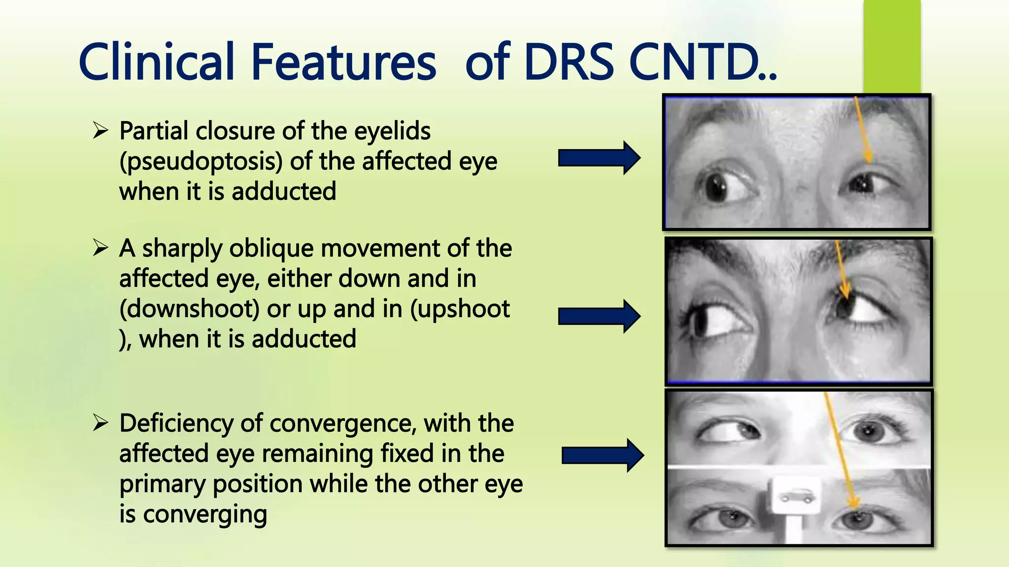 Duane's Retraction Syndrome.pptx | Physical Therapy | Wellness