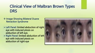 Duane's Retraction Syndrome.pptx