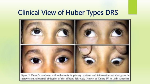 Duane's Retraction Syndrome.pptx | Physical Therapy | Wellness