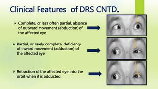 Duane's Retraction Syndrome.pptx