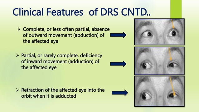 Duane's Retraction Syndrome.pptx | Physical Therapy | Wellness