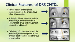 Duane's Retraction Syndrome.pptx