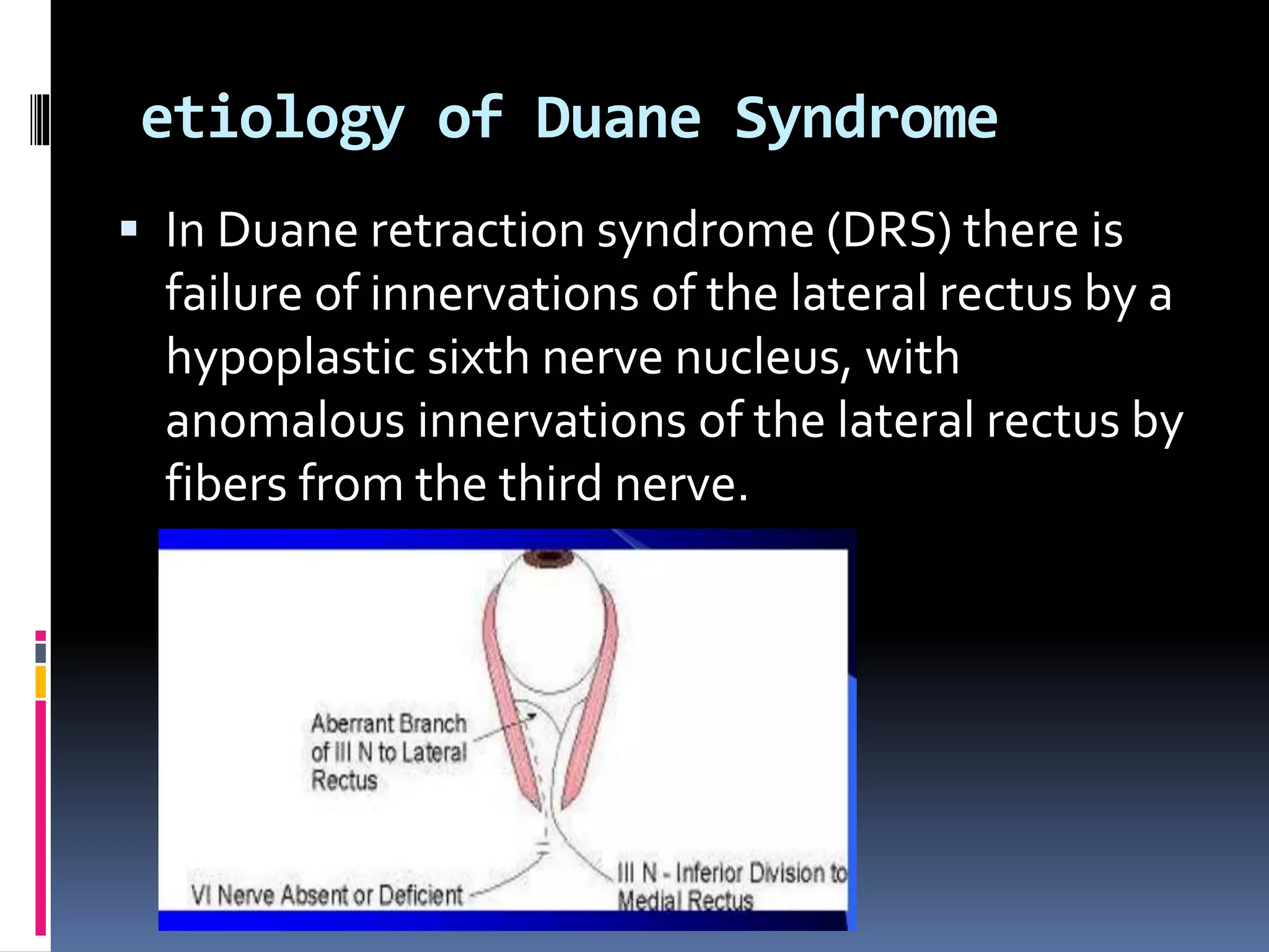 Duane syndrome 2 | PPSX