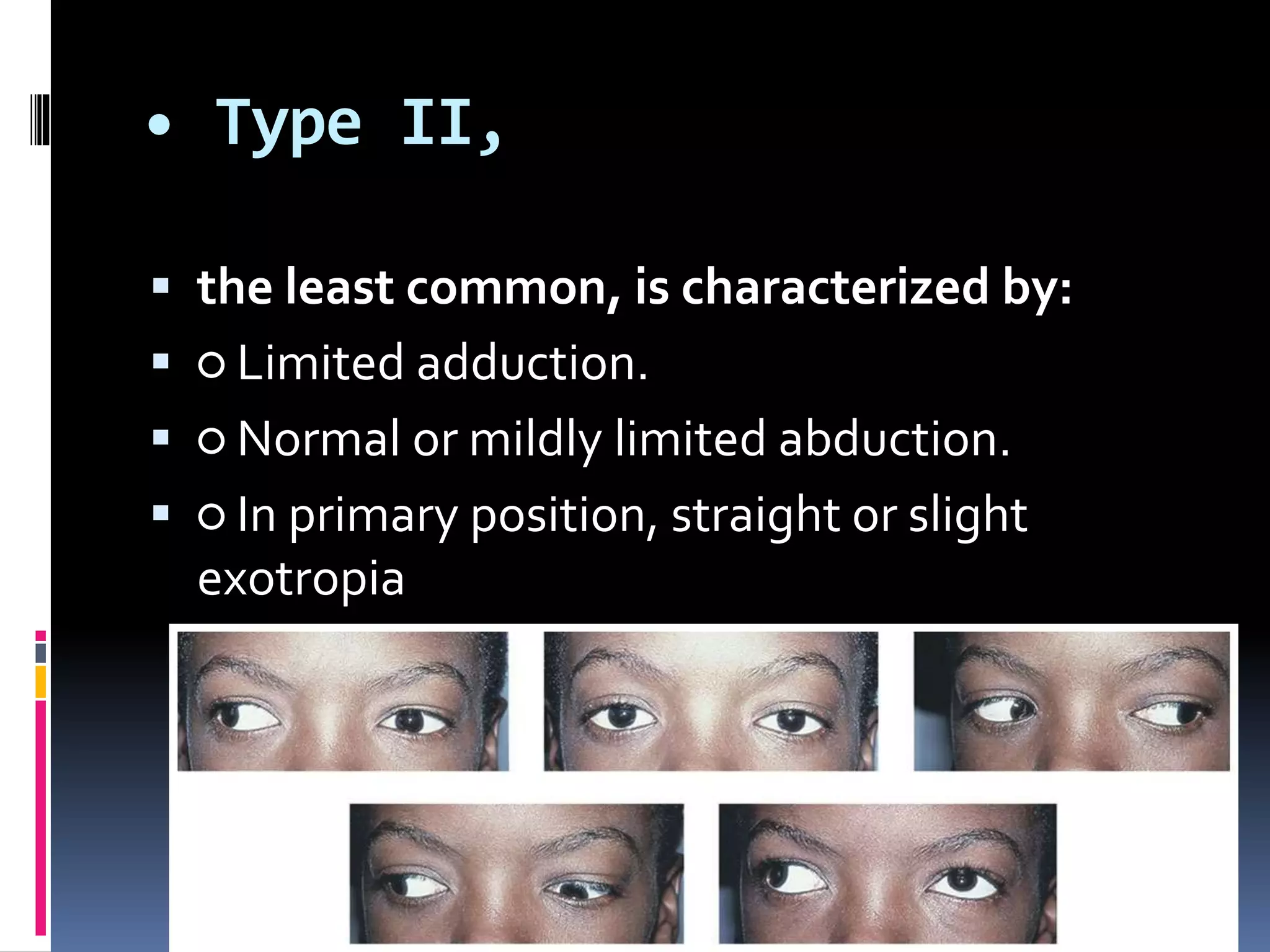 Duane syndrome 2 | PPSX