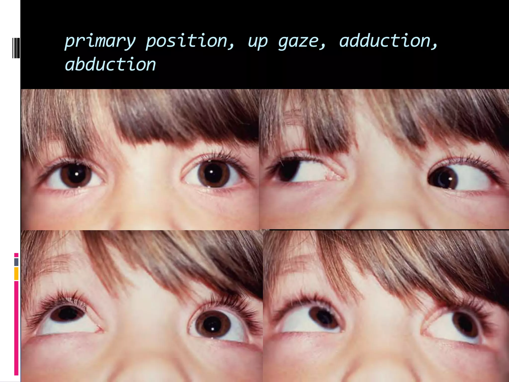 Duane syndrome 2 | PPSX