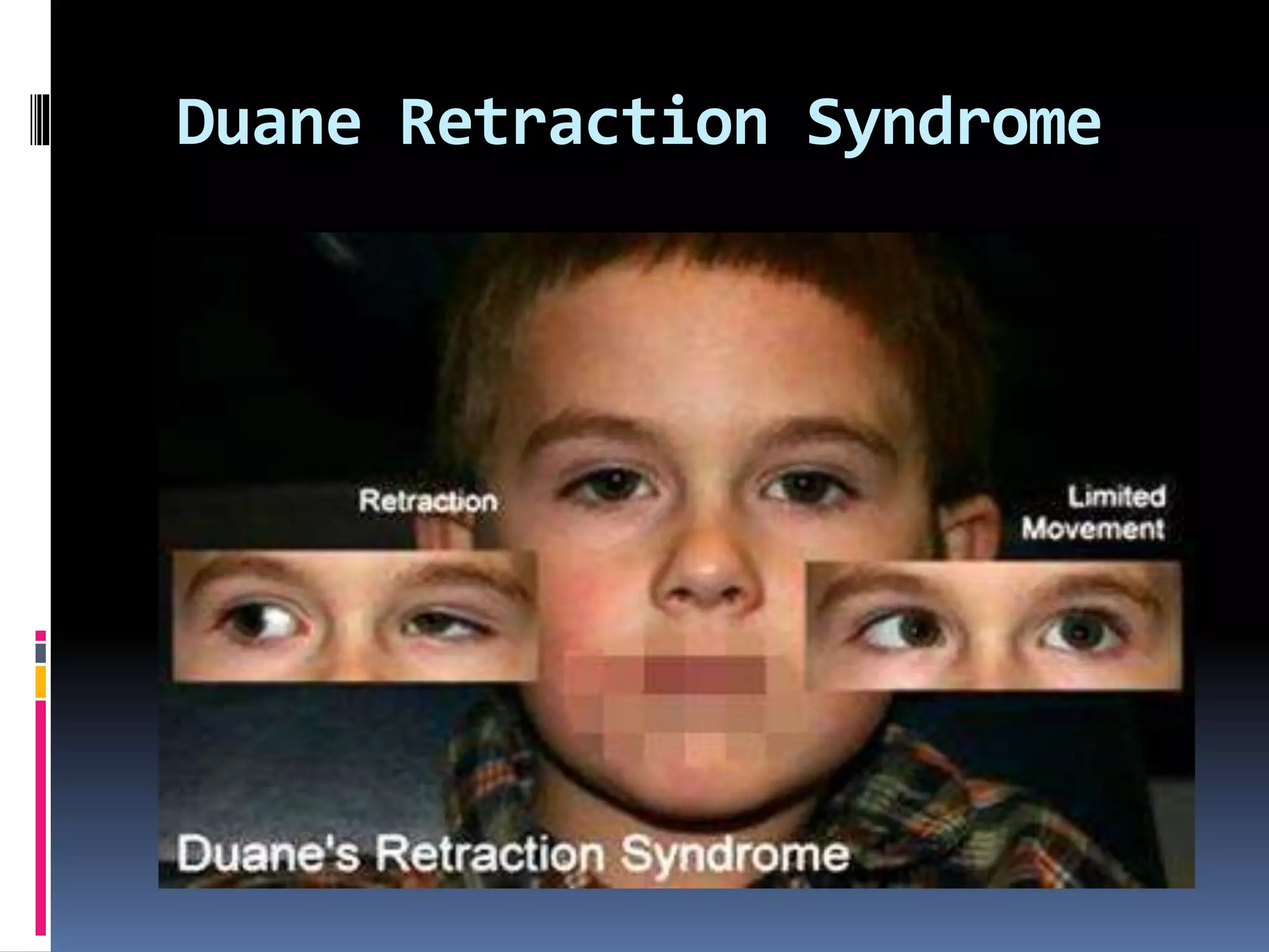 Duane syndrome 2 | PPSX