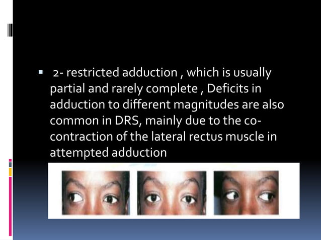 Duane syndrome 2 | PPSX | Eye and Vision Conditions | Diseases and ...
