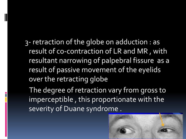 Duane syndrome 2 | PPSX | Eye and Vision Conditions | Diseases and ...