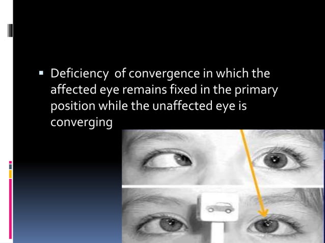 Duane syndrome 2 | PPSX | Eye and Vision Conditions | Diseases and ...