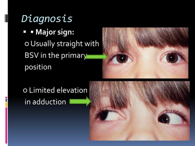 Duane syndrome 2 | PPSX | Eye and Vision Conditions | Diseases and ...
