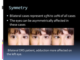 Duane syndrome 2 | PPSX