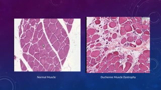 Duchenne muscular dystrophy and Kartagener's syndrome | PPTX