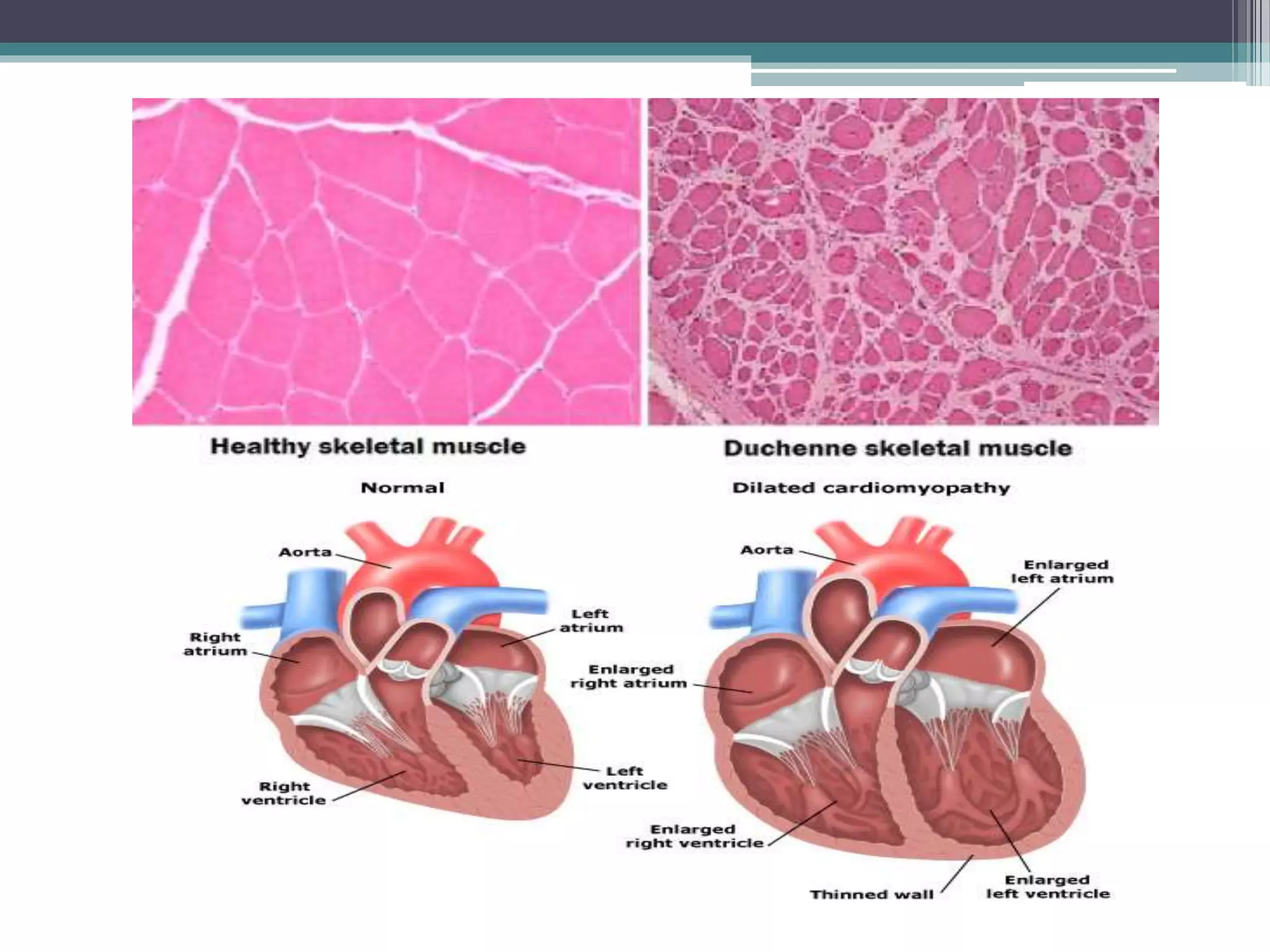 Duchene’s muscular dystrophy | PPTX