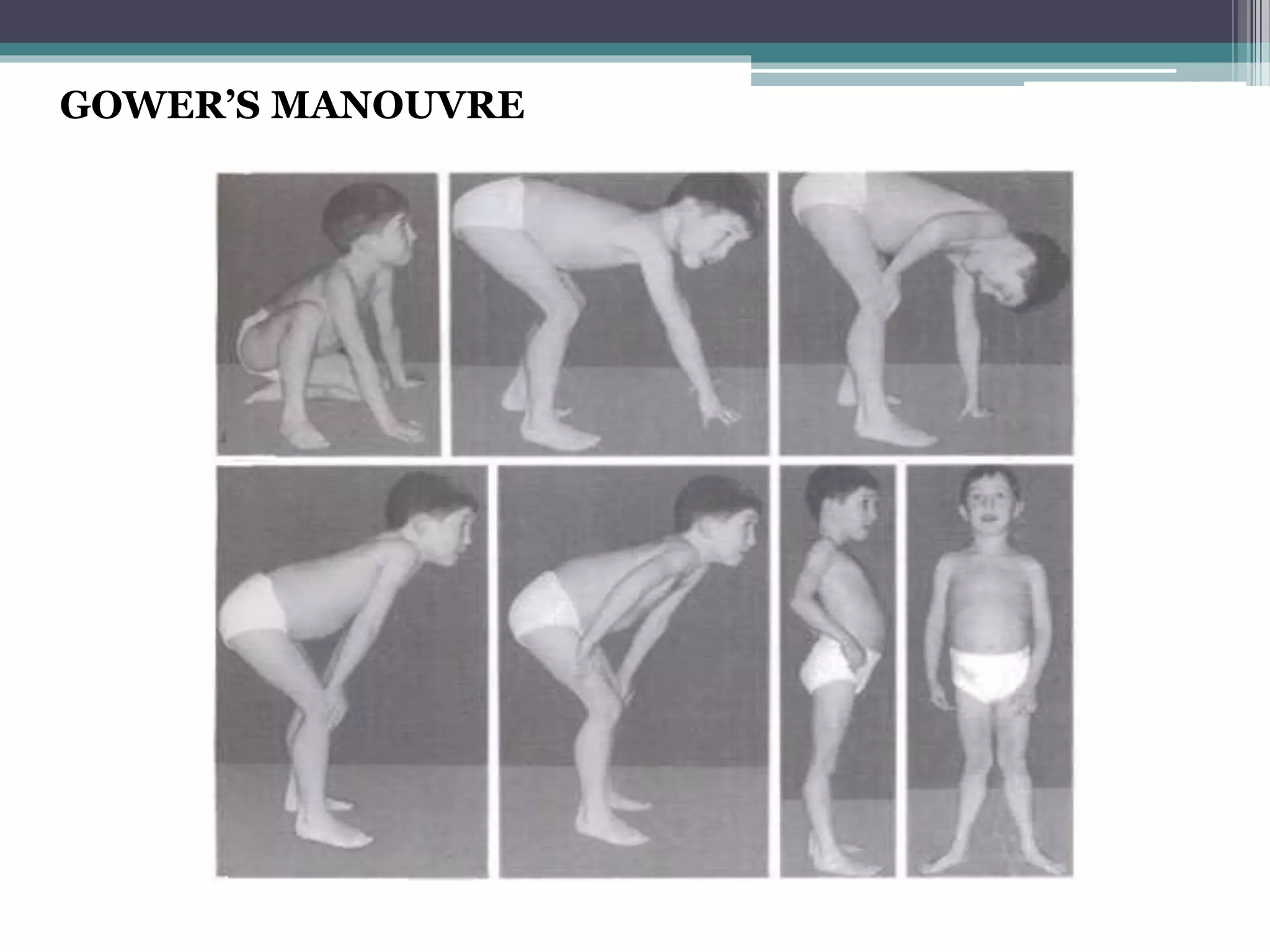 Duchene’s muscular dystrophy | PPTX