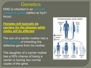 Duchenne muscular dystrophy | PPTX