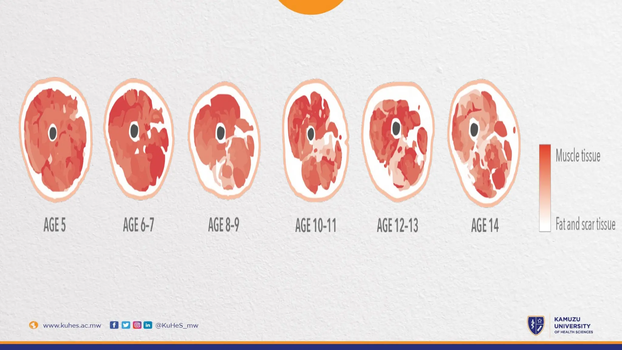 DUCHENNE MUSCULAR DYSTROPHY. Pathophysiology and management | PPT
