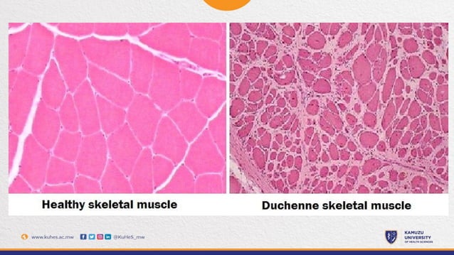 DUCHENNE MUSCULAR DYSTROPHY. Pathophysiology and management | PPT