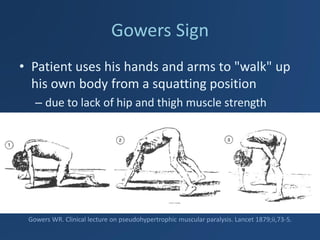 Gowers Sign