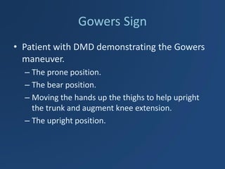 Duchenne Muscular Dystrophy | PPT