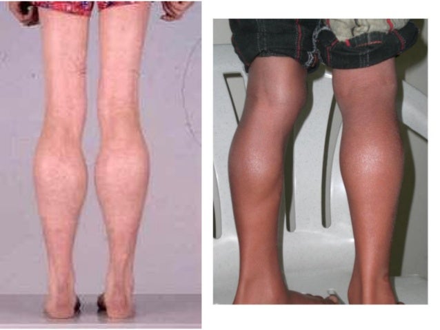 Muscular Dystrophy Patients