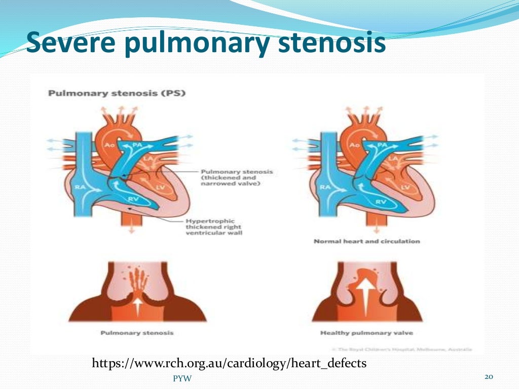 duct dependent heart lesions by Dr Parashuram Waddar 2021 ppt, for Pe…