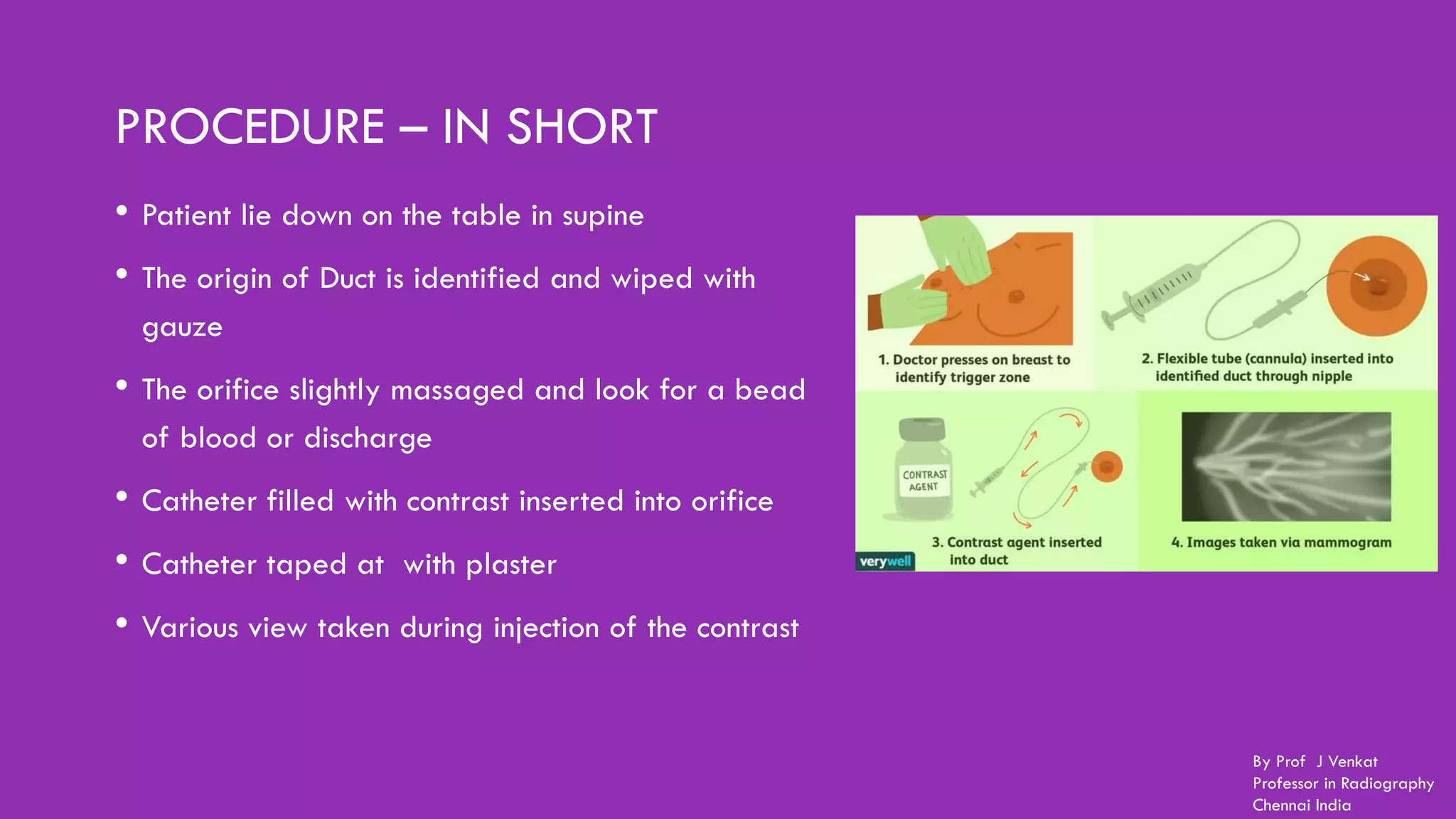 Ductography by prof j venkat | PDF