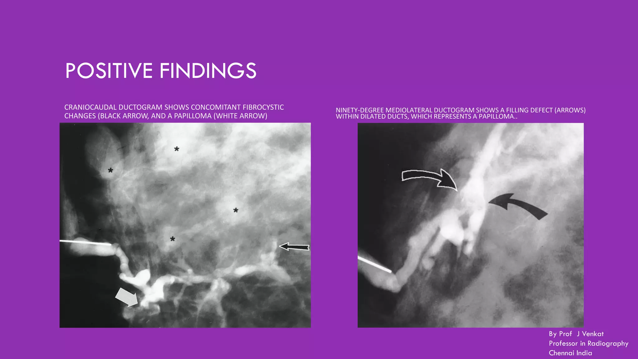 Ductography by prof j venkat | PDF