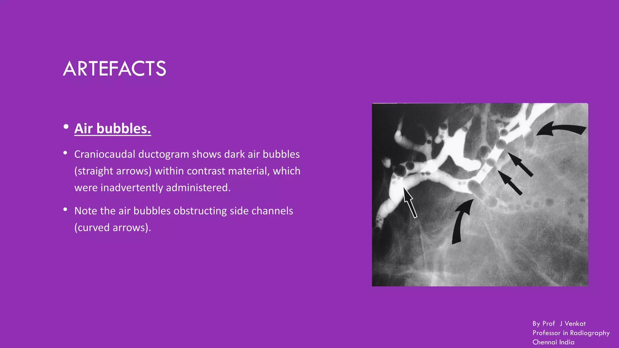 Ductography by prof j venkat | PDF